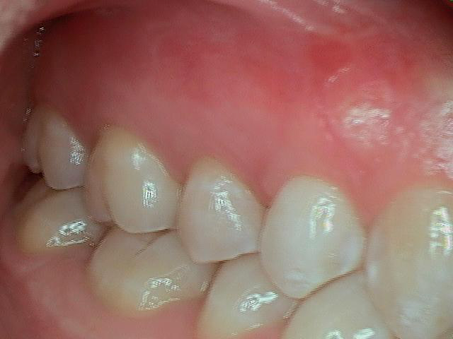 Pinhole Surgical Technique Perrysburg OH | PST | Gum Treatment